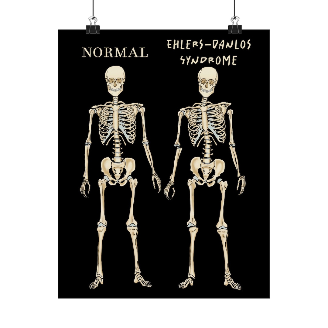 Ehlers-danlos Syndrome Poster, EDS Poster, EDS Skeleton Humor, Ehlers ...
