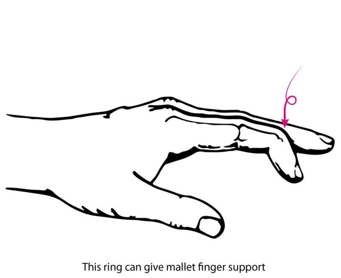 Double Joint Ring Splint Support Hypermobility Trigger Finger - Etsy