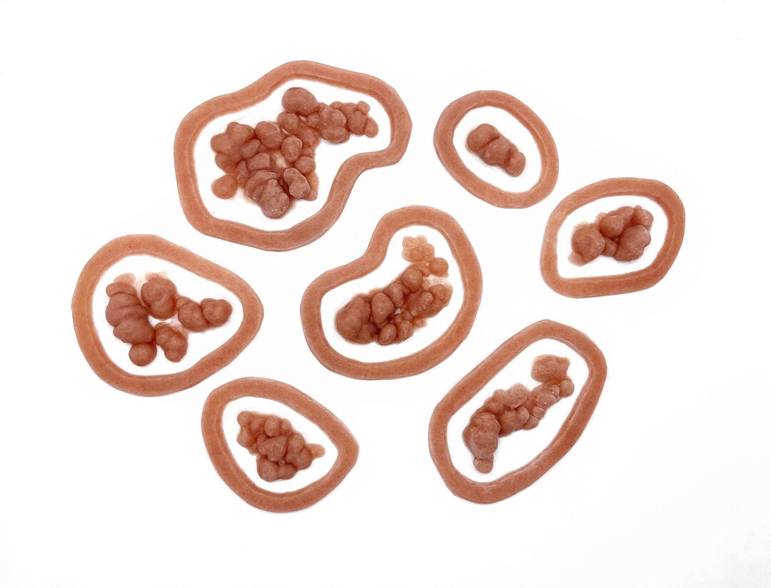 Cyst Growth Pack / Boils / Encapsulated Silicone Prosthetic / Abscess ...