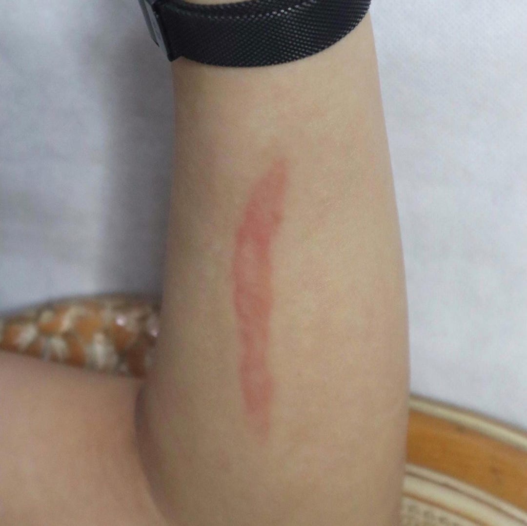Keloid Scar Temporary Tattoo: Realistic SFX Makeup, Cosplay Prop - Etsy