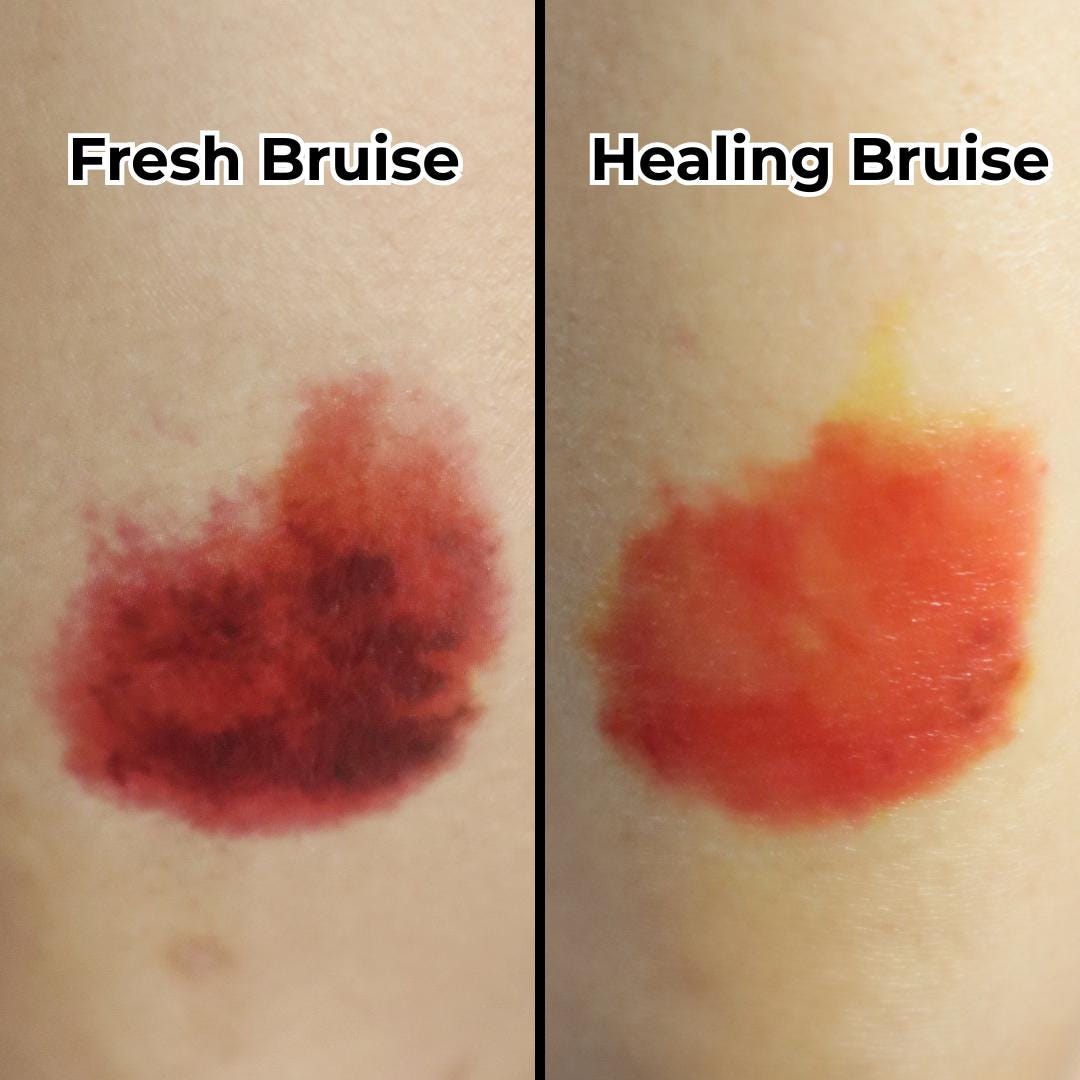 Fresh & Healing Bruise Temporary Tattoo: SFX Halloween Cosplay Makeup ...