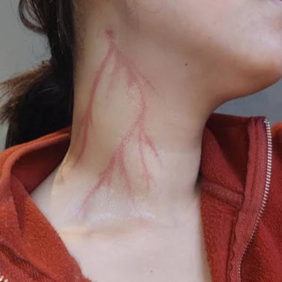Lightning strike tattoo scar - Bronctattooaus.com