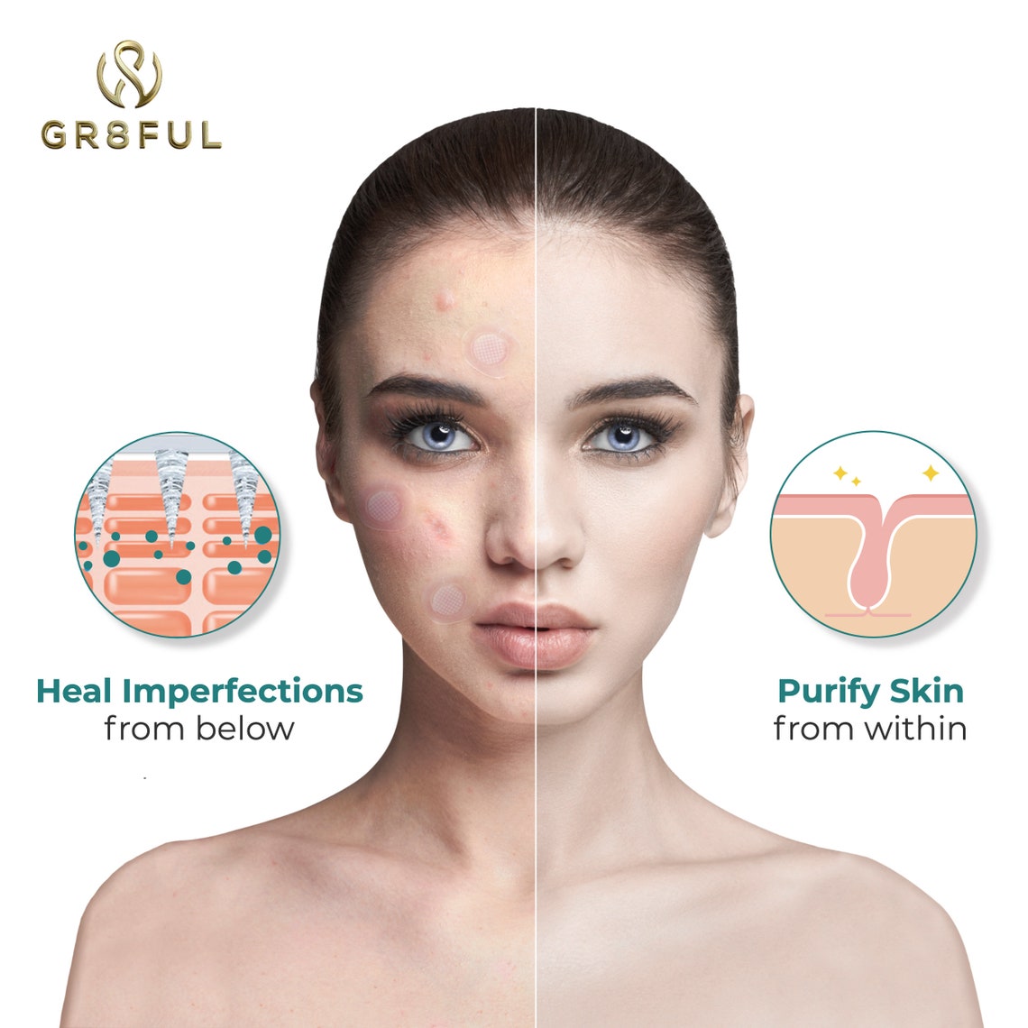 Deep Acne Clarifying Microneedle Pimple Patch 18 Patches Tea Tree ...