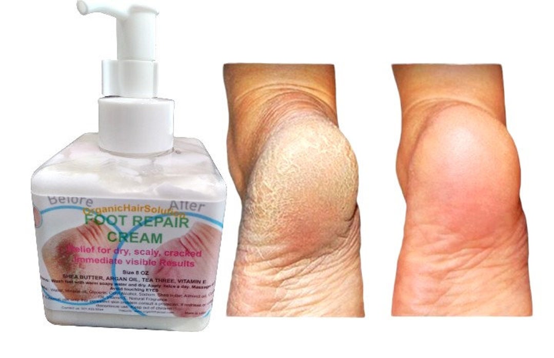 FOOT REPAIR CREAM- for Dry Cracked Feet, Athletes Foot, Nail Fungus ...