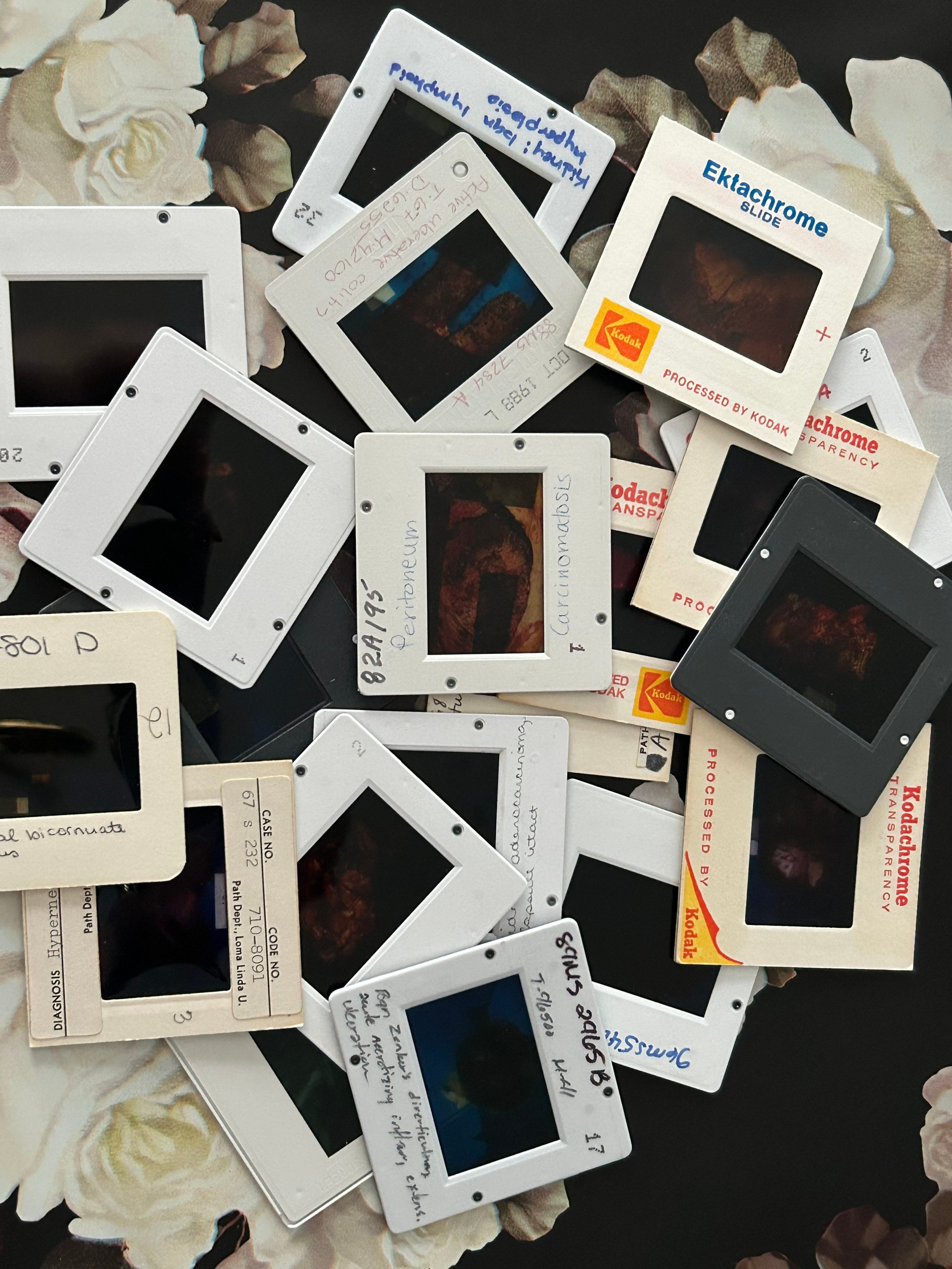 Five Random Vintage Medical Slides of Human Organs and Diseased Tissue ...