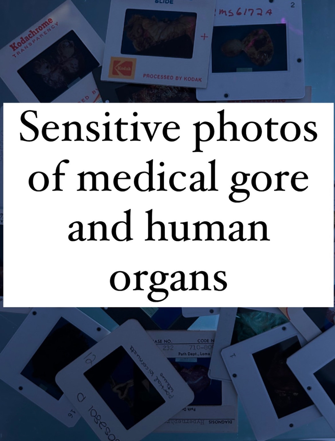 Five Random Vintage Medical Slides of Human Organs and Diseased Tissue ...