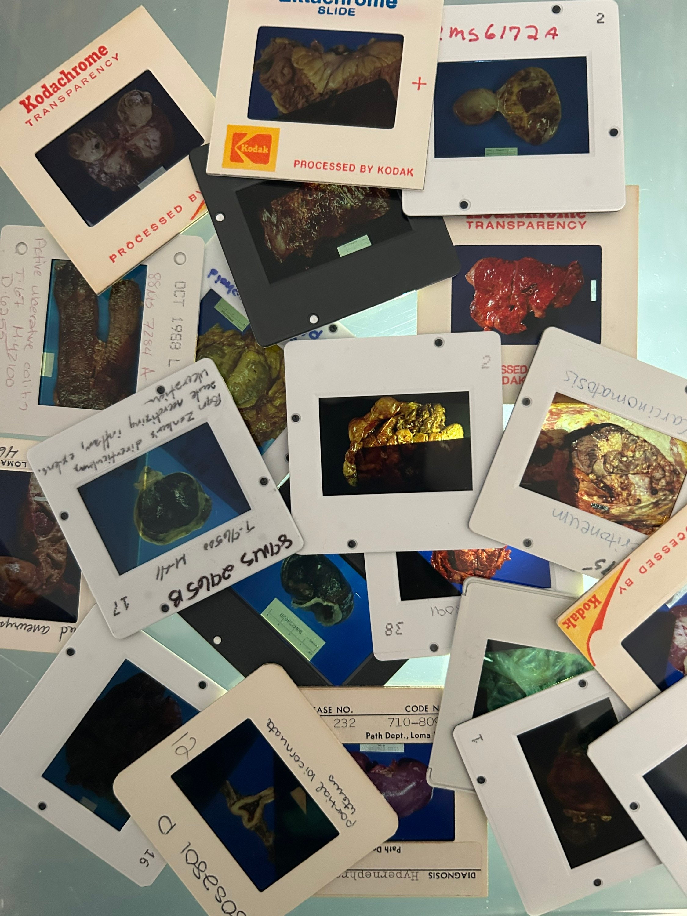 Five Random Vintage Medical Slides of Human Organs and Diseased Tissue ...