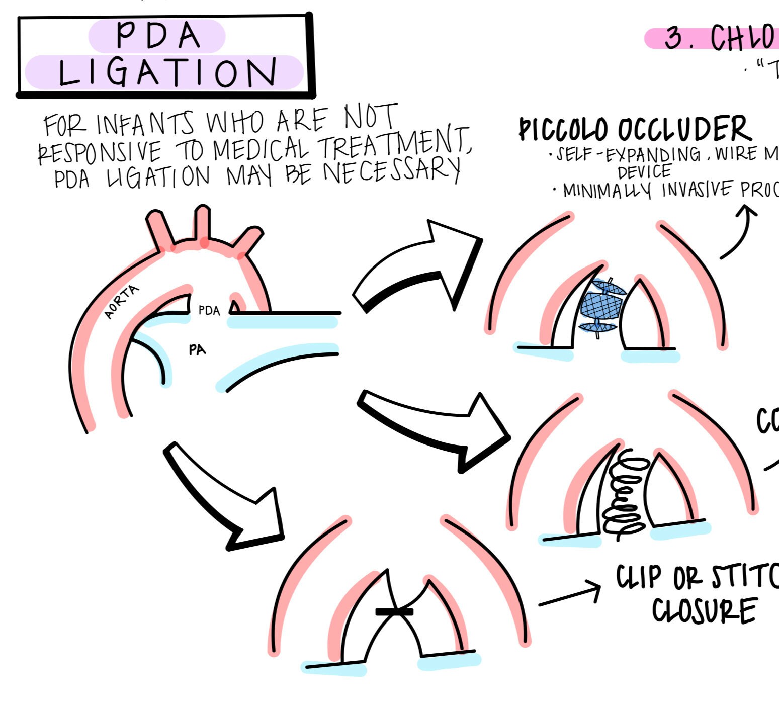 PDA Closure + Common Diuretics - Etsy