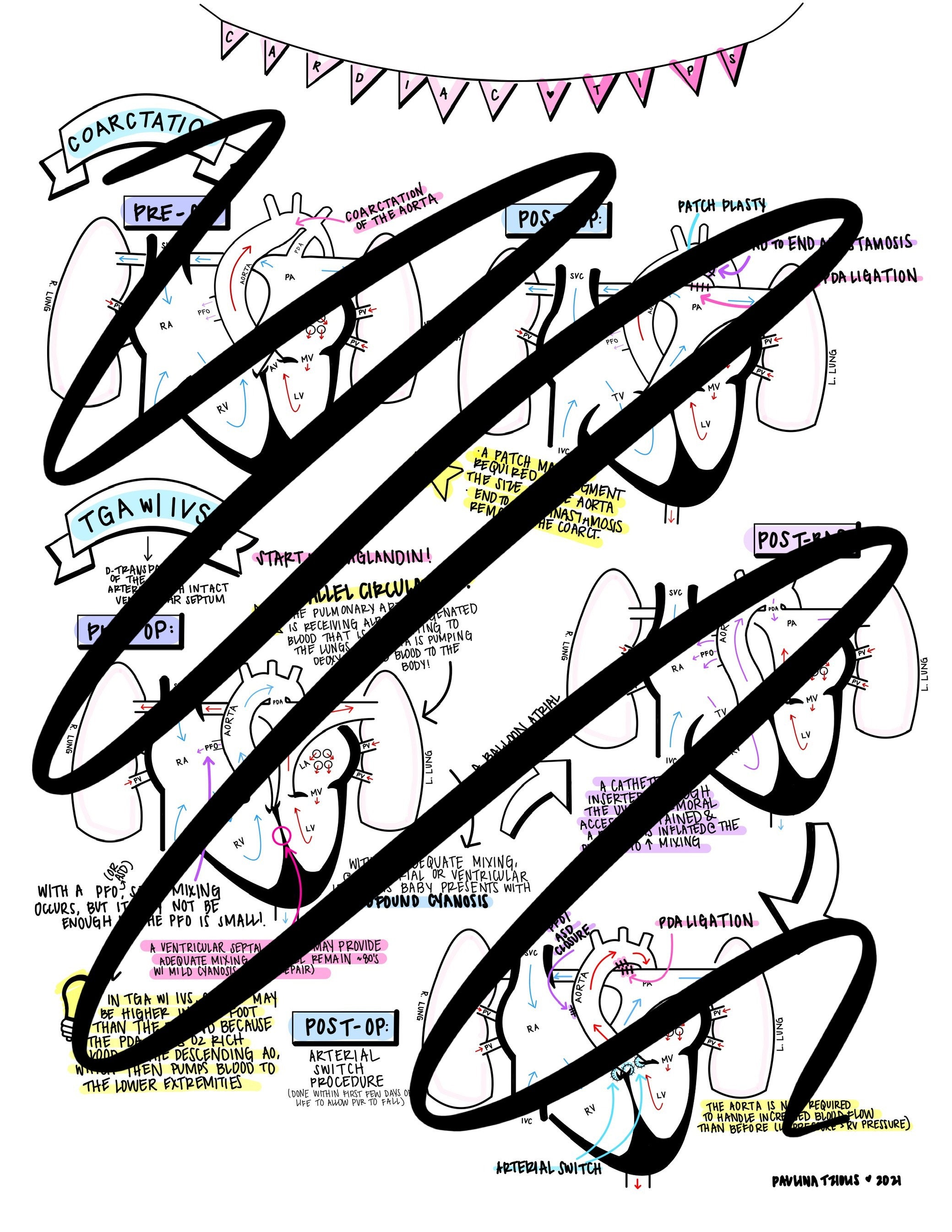 Coarctation + TGA With IVS (pre/post Op) : Nicu Nursing & Nnp Notes - Etsy