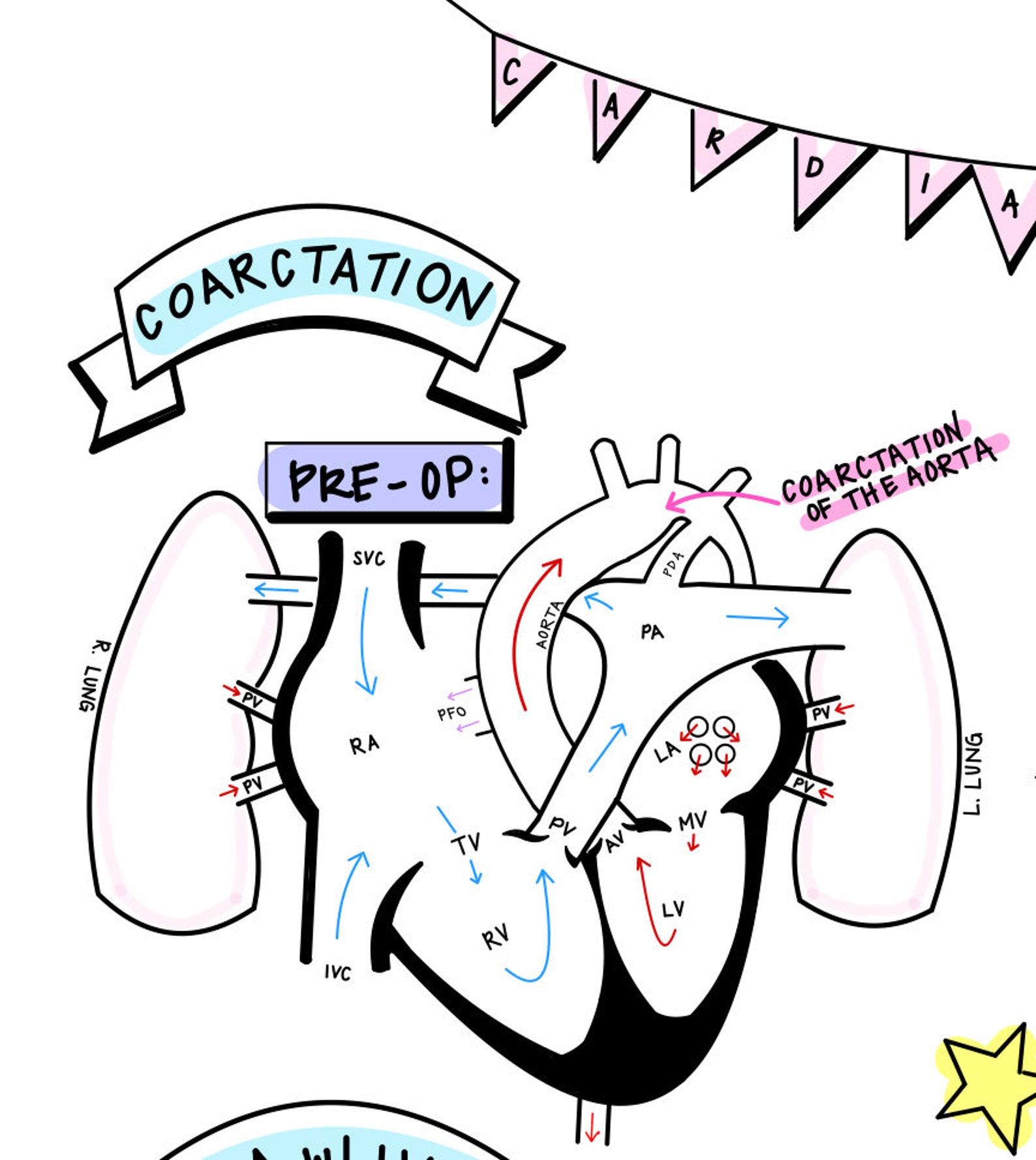 Coarctation + TGA With IVS (pre/post Op) : Nicu Nursing & Nnp Notes - Etsy