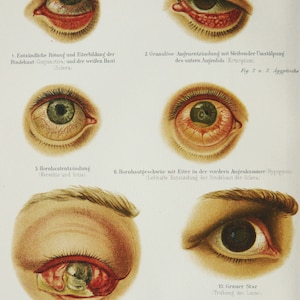 1897 Antique Bizarre Lithograph of OPHTHALMOLOGY: HUMAN EYES. Eyeball ...