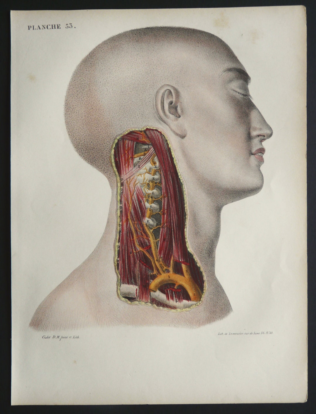 1867 Antique Engraving of HUMAN ANATOMY: HEAD, Neck. Surgery. Doctor ...