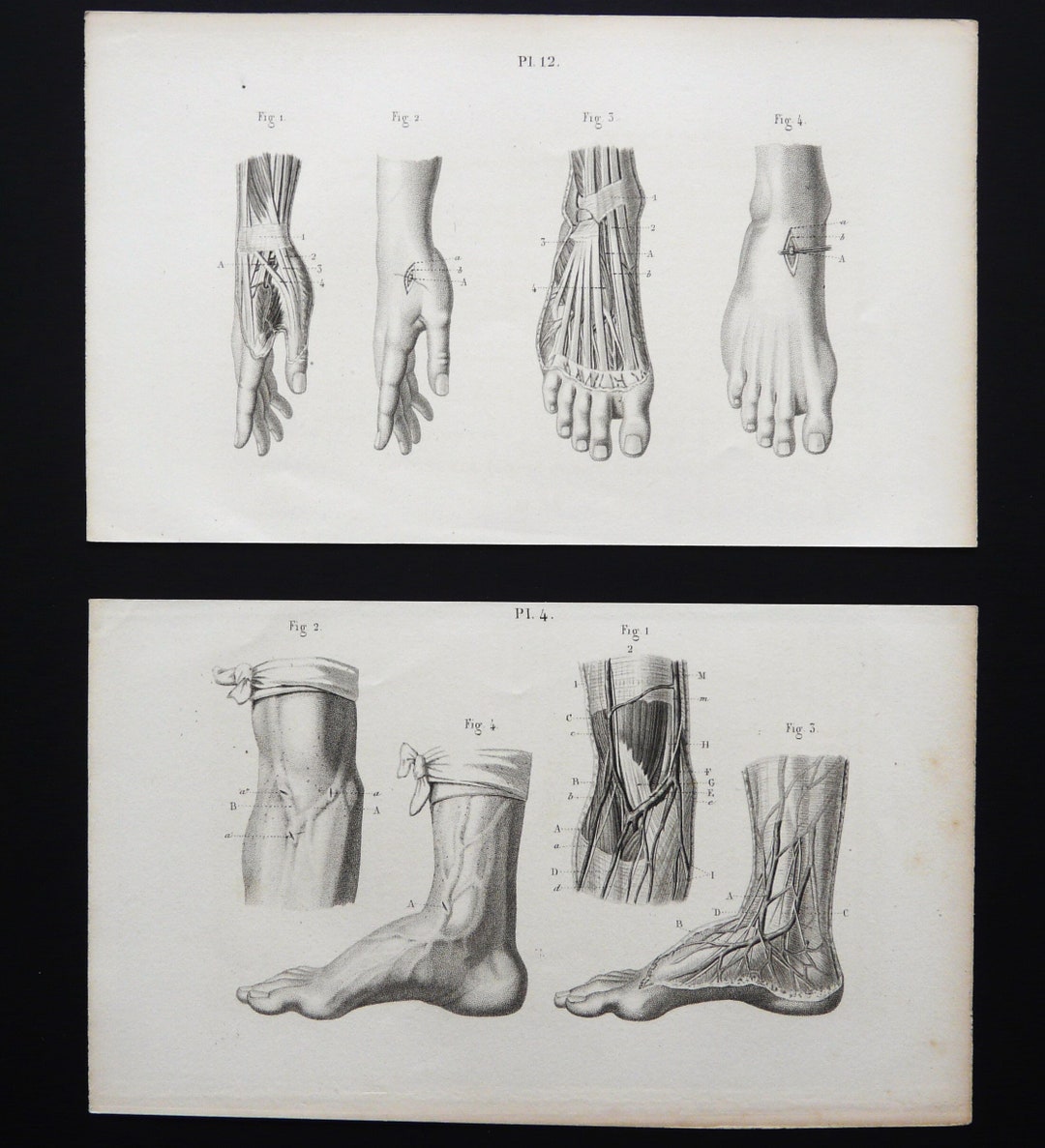 1848 Set of Two Antique Prints: HUMAN FEET, Bones, Muscles. Podiatric ...