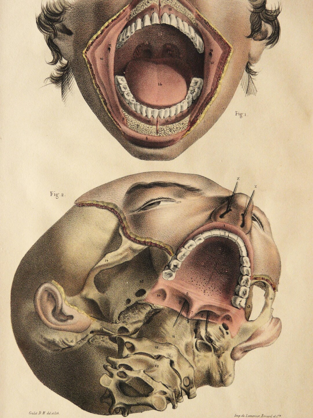 1867 Antique Engraving of HUMAN ANATOMY: HEAD. Otorhinolaryngology. Orl ...