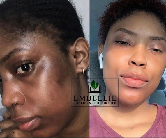 Kojic Acid Before And After
