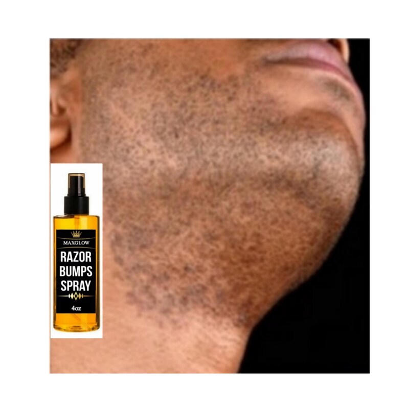 Razor Bumps Spray, Beard , Head, Bikini Area - Etsy
