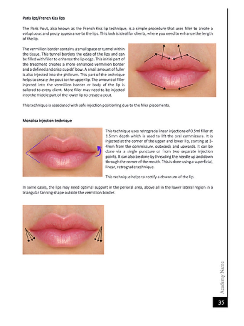 Advanced Dermal Filler Lip Techniques Editable Training Manual | Etsy