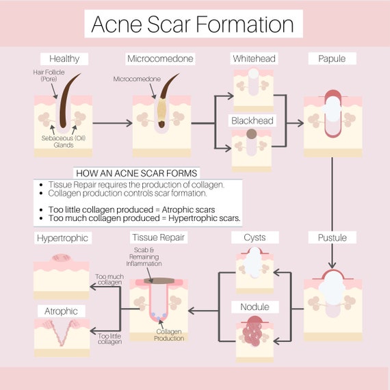 Acne Scar Diagram