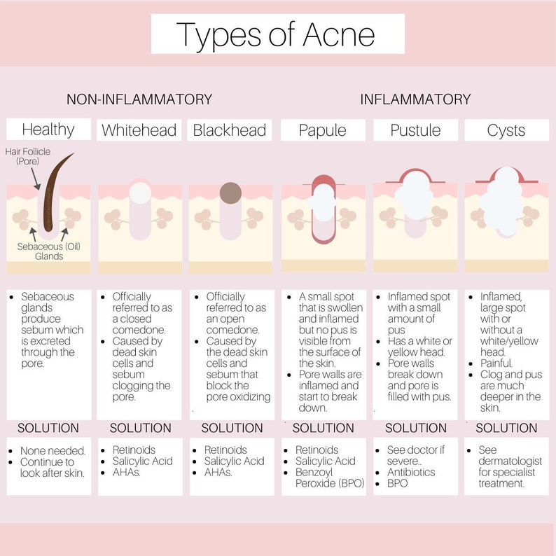 Types Of Acne Diagram Etsy