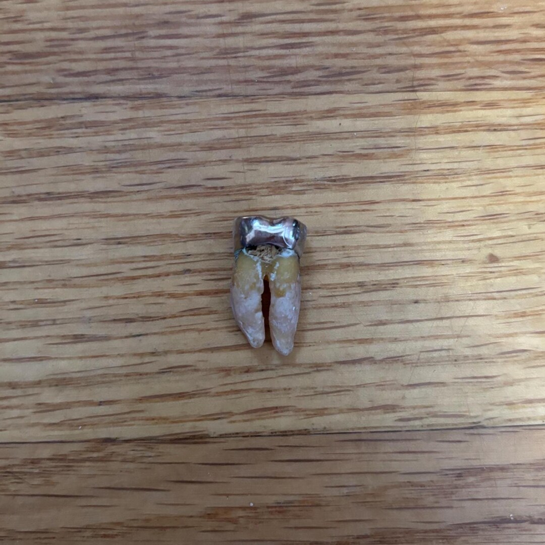 One Real Human Tooth With Half Crown/ Half Silver Cap - Etsy