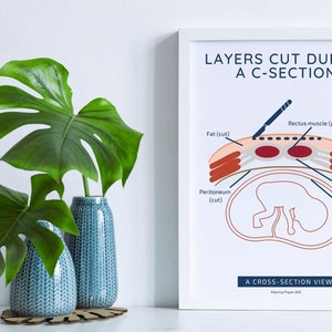 Cesarean | C-section | Birth Art Poster | Pelvic Physical Therapy ...