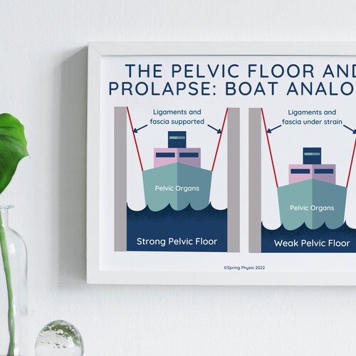 Physical Therapy Pelvic Floor Poster Pelvic Floor Physical - Etsy