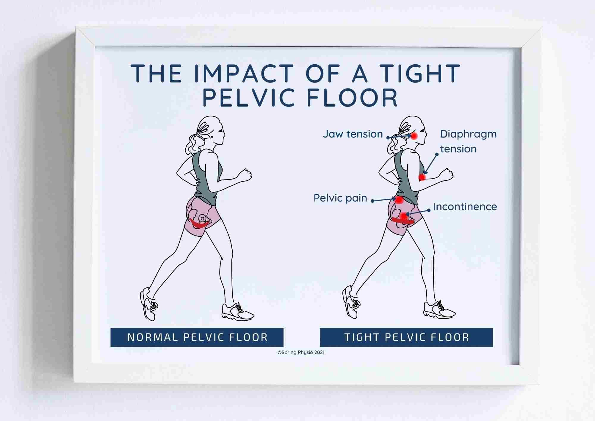 Physical Therapy Pelvic Floor Hypertonic Pelvic Floor Pelvic Art Pelvic Poster - Etsy UK