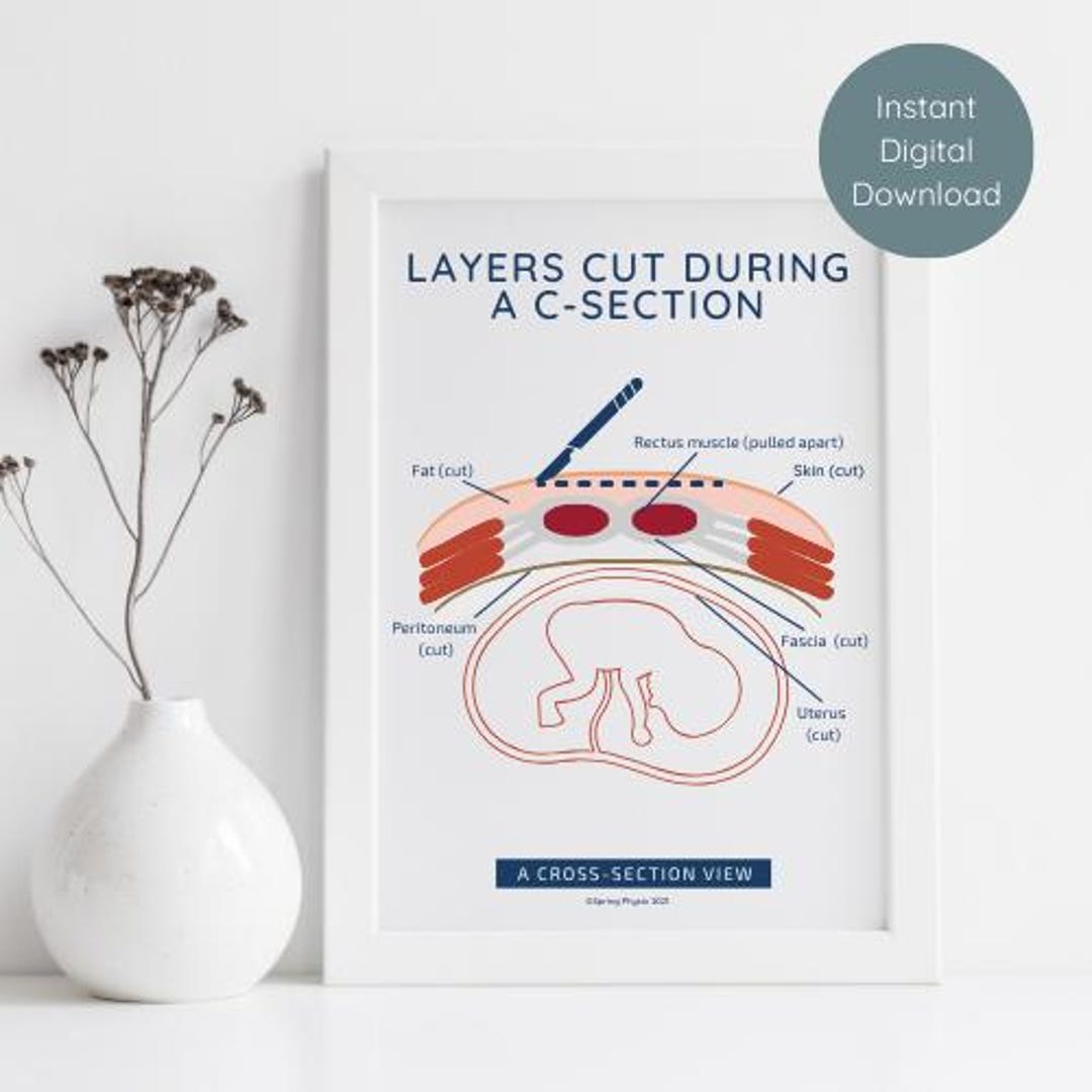 Cesarean | C-section | Birth Art Poster | Pelvic Physical Therapy ...