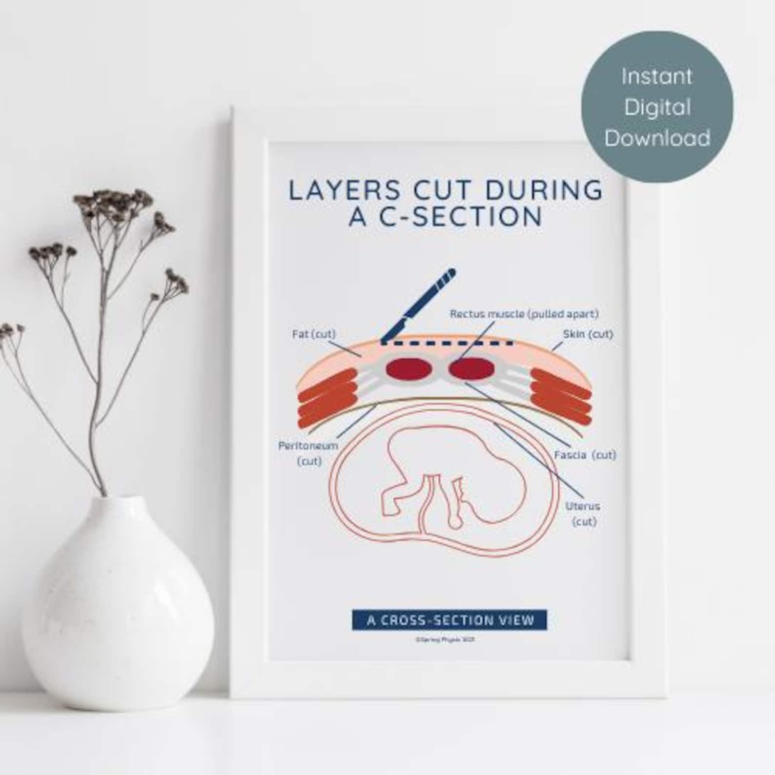 C-section Layers Art Print | Midwife Pelvic Therapy Education (digital ...