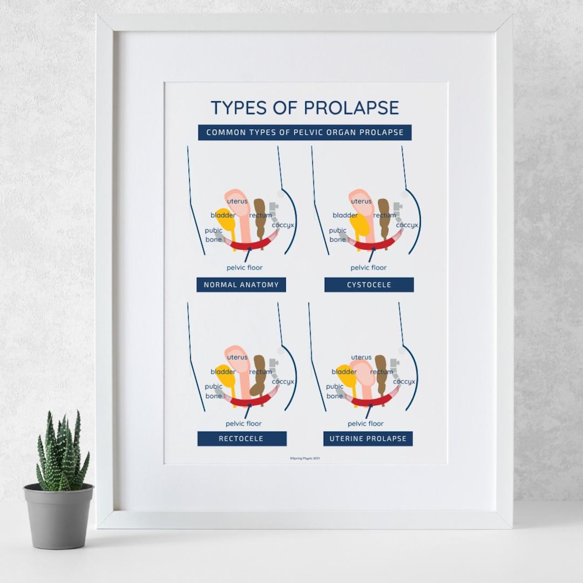 A4 Anatomy Poster | Pelvic Organ Prolapse Poster | Pelvic Floor ...