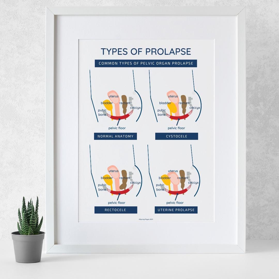 Pelvic Organ Prolapse Anatomy Education Poster | Pelvic Floor Art ...
