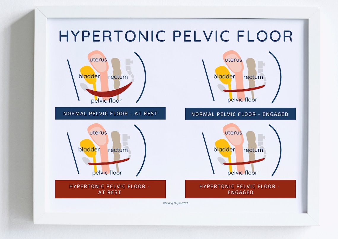Pelvic Floor Physical Therapist Poster | Hypertonic Pelvic Floor| Pelvic Floor Physical Therapy ...