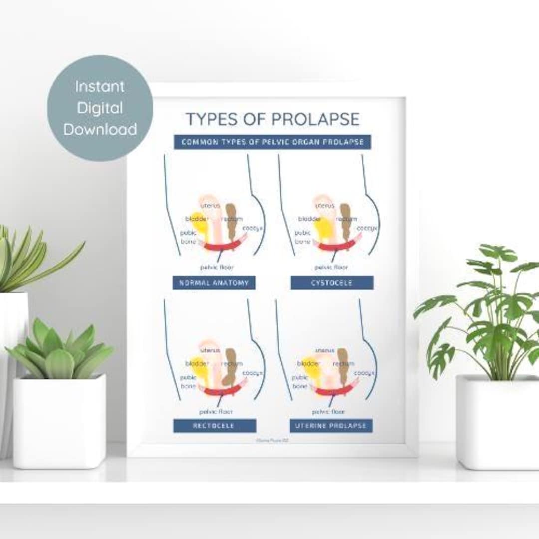 Pelvic Organ Prolapse Anatomy Education Poster | Pelvic Floor Art ...