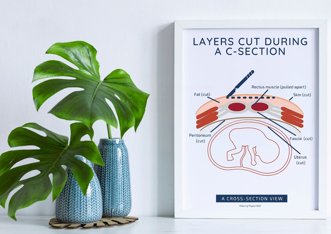 Cesarean | C-section | Birth Art Poster | Pelvic Physical Therapy ...