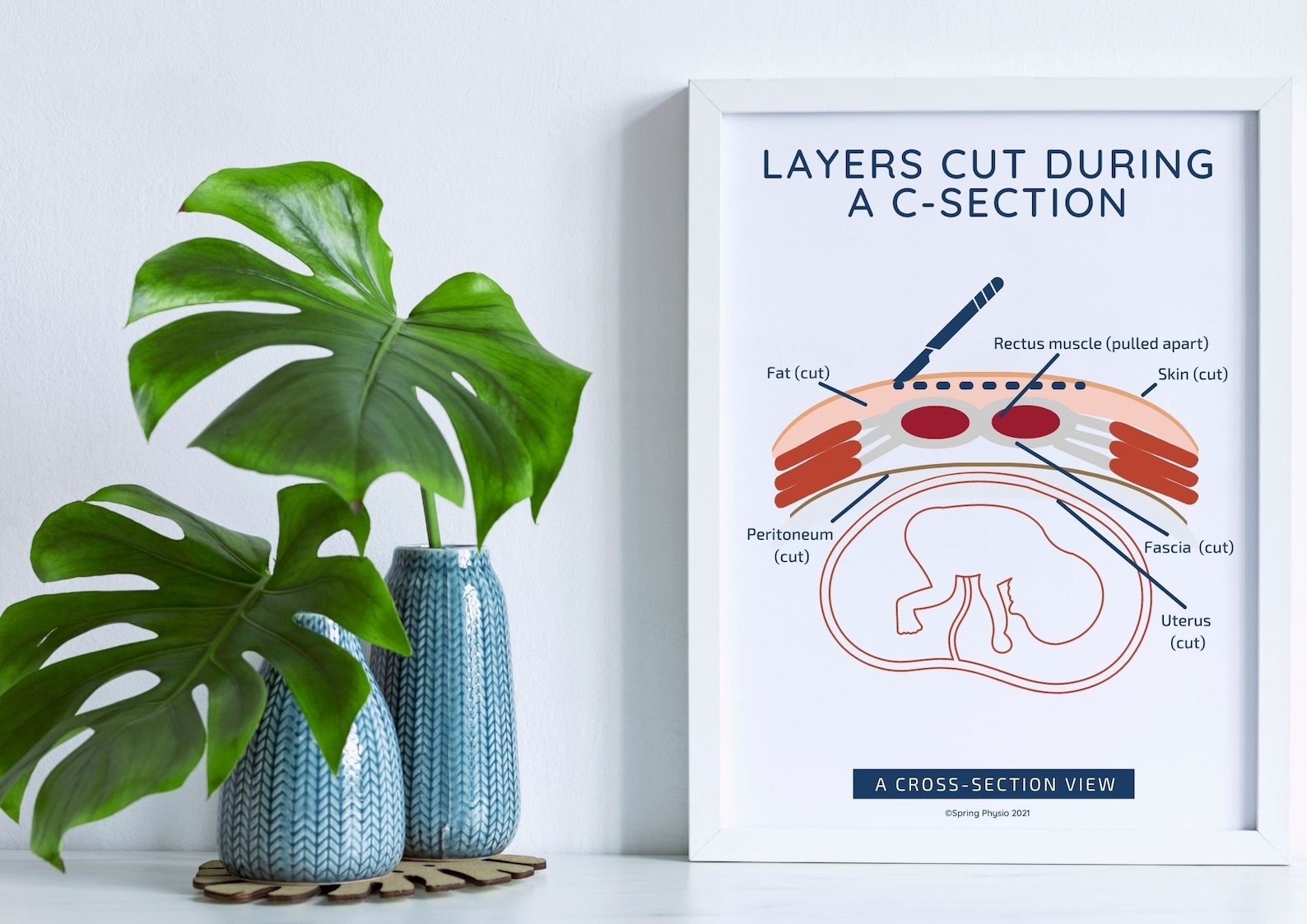 C-section Layers Art Print | Midwife Pelvic Therapy Education (digital ...