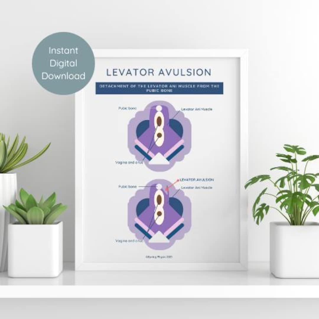 Pelvic Floor Anatomy Print | Levator Avulsion Art (digital Download) - Etsy