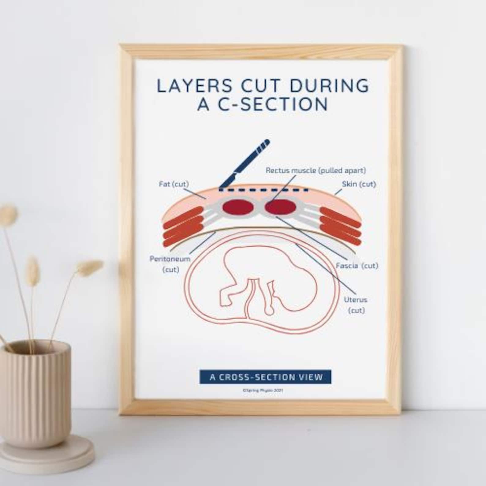 Cesarean | C-section | Birth Art Poster | Pelvic Physical Therapy ...