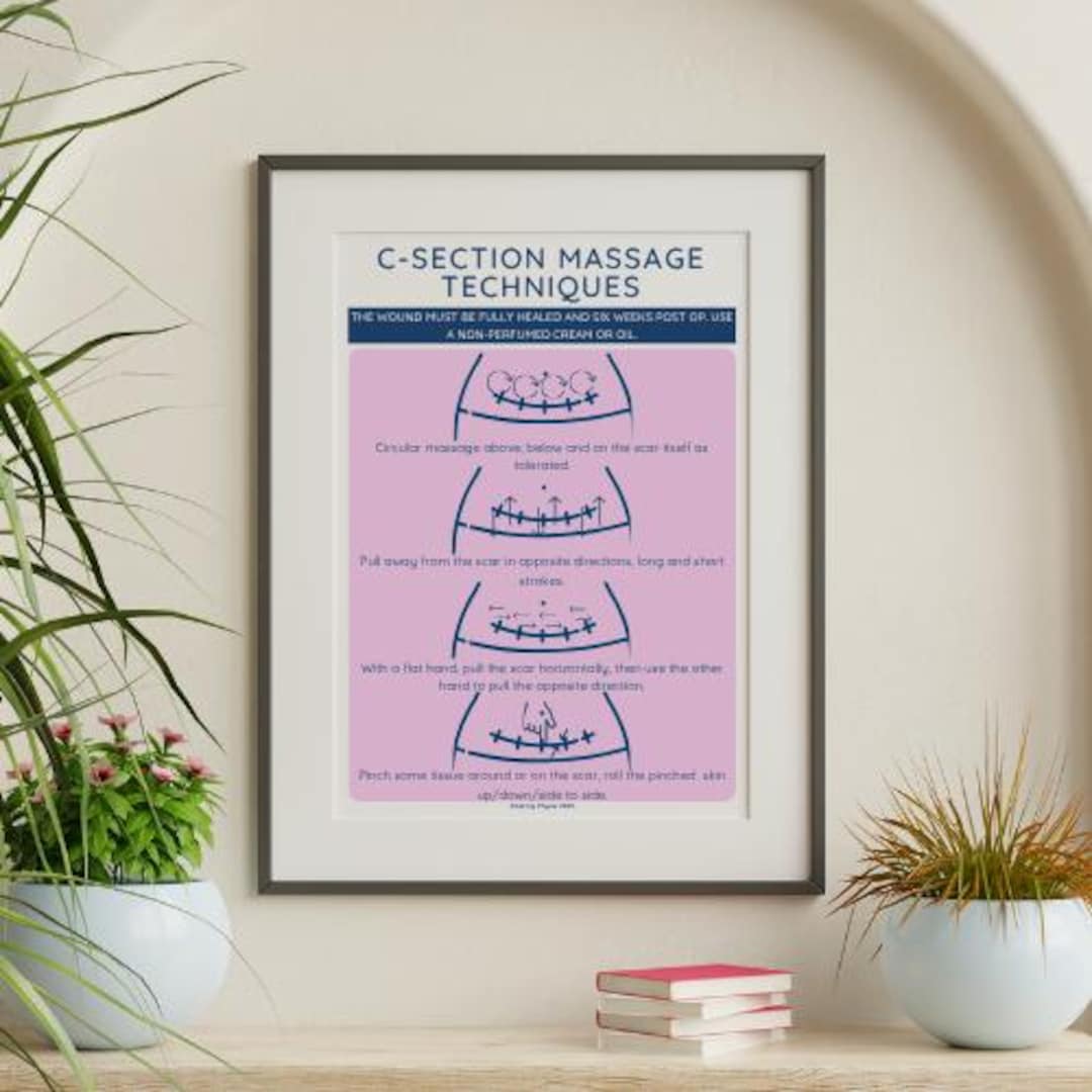 C-section Scar Massage Techniques Art Print (digital Download) - Etsy