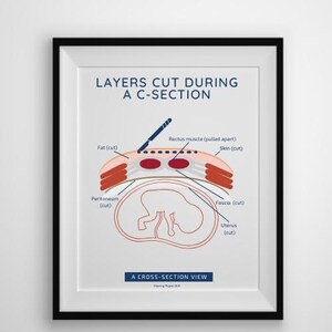 C-section Layers Art Print | Midwife Pelvic Therapy Education (digital ...