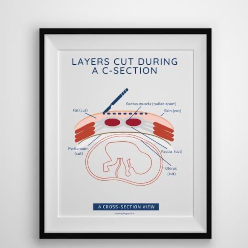 Cesarean | C-section | Birth Art Poster | Pelvic Physical Therapy ...