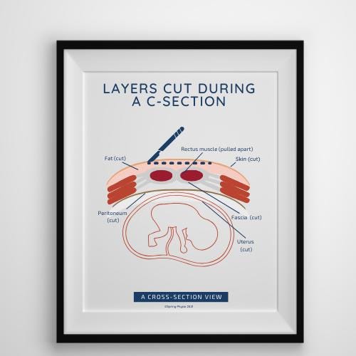 C-section Layers Art Print | Midwife Pelvic Therapy Education (digital ...