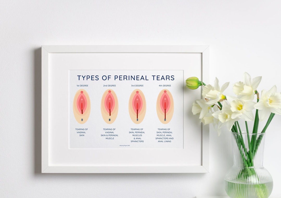 Birth Education Poster | Perineal Tears | Midwife Education Poster ...
