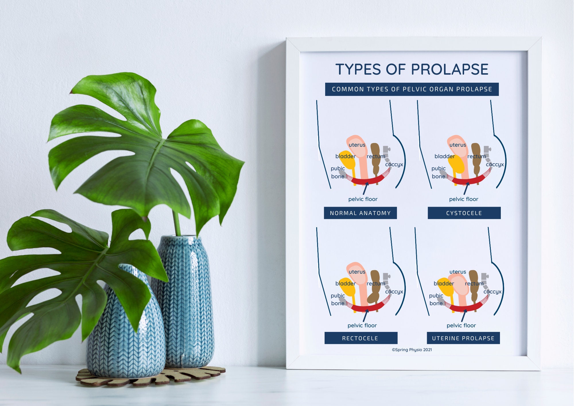 A4 Anatomy Poster Pelvic Organ Prolapse Poster Pelvic Floor Pelvic ...