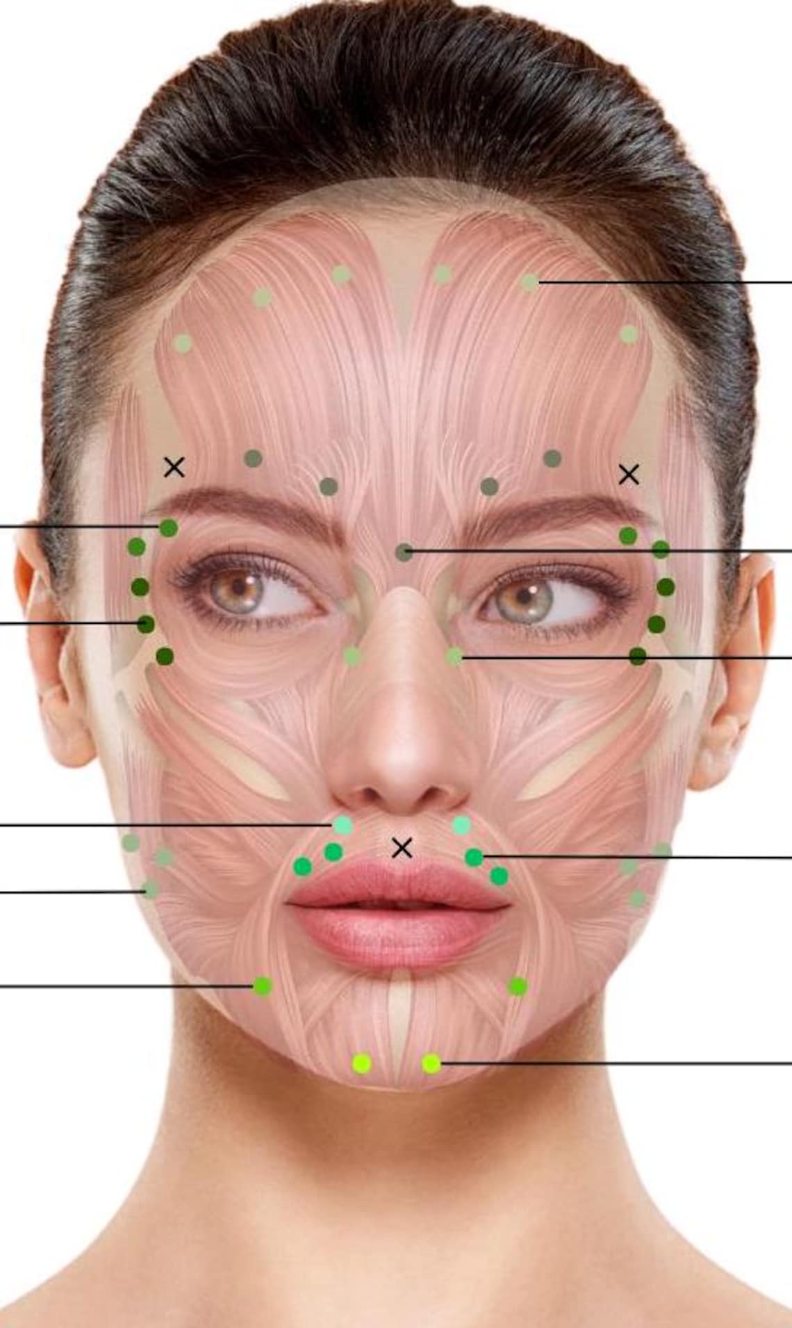 Toxin Injection Placement Chart – Female | Aesthetic Injector Guide ...