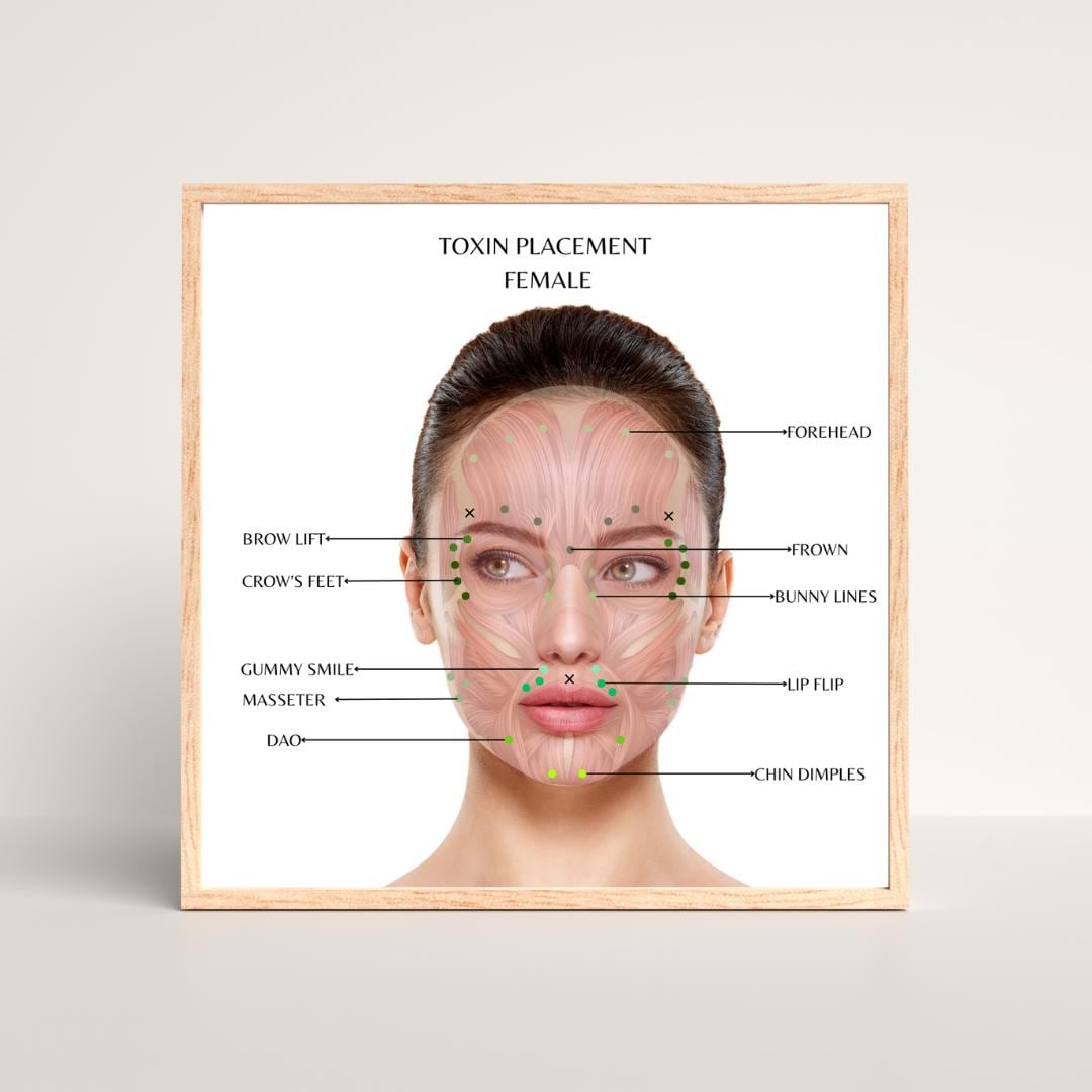 Oxin Injection Placement Chart – Female | Aesthetic Injector Guide ...