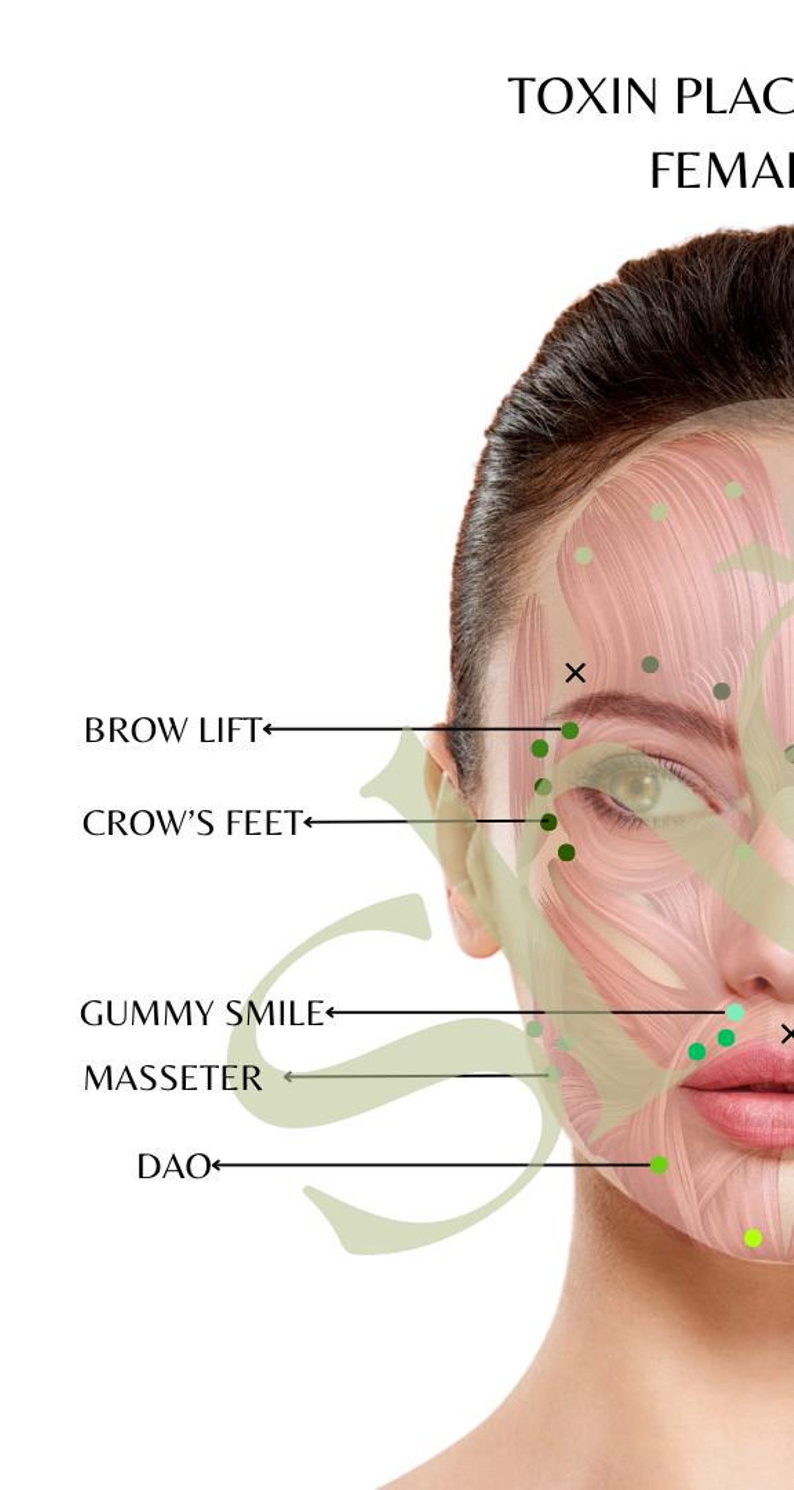 Toxin Injection Placement Chart – Female | Aesthetic Injector Guide ...