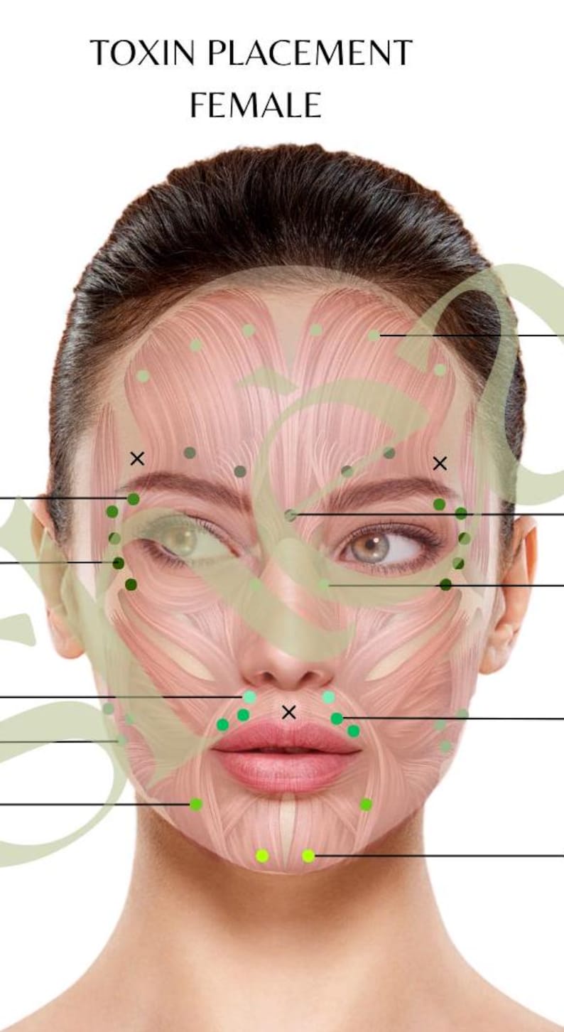 Toxin Injection Placement Chart – Female | Aesthetic Injector Guide ...