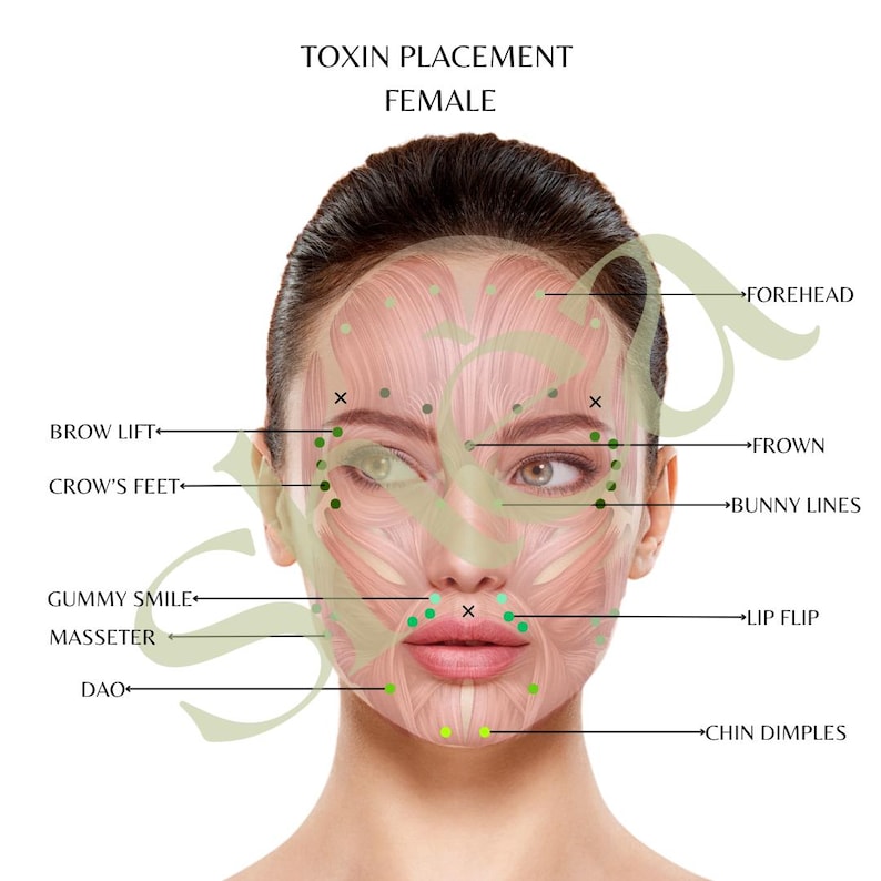 Toxin Injection Placement Chart – Female | Aesthetic Injector Guide ...
