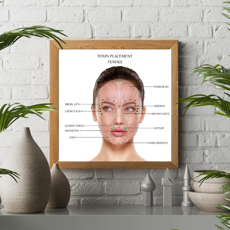 Toxin Injection Placement Chart – Female | Aesthetic Injector Guide ...