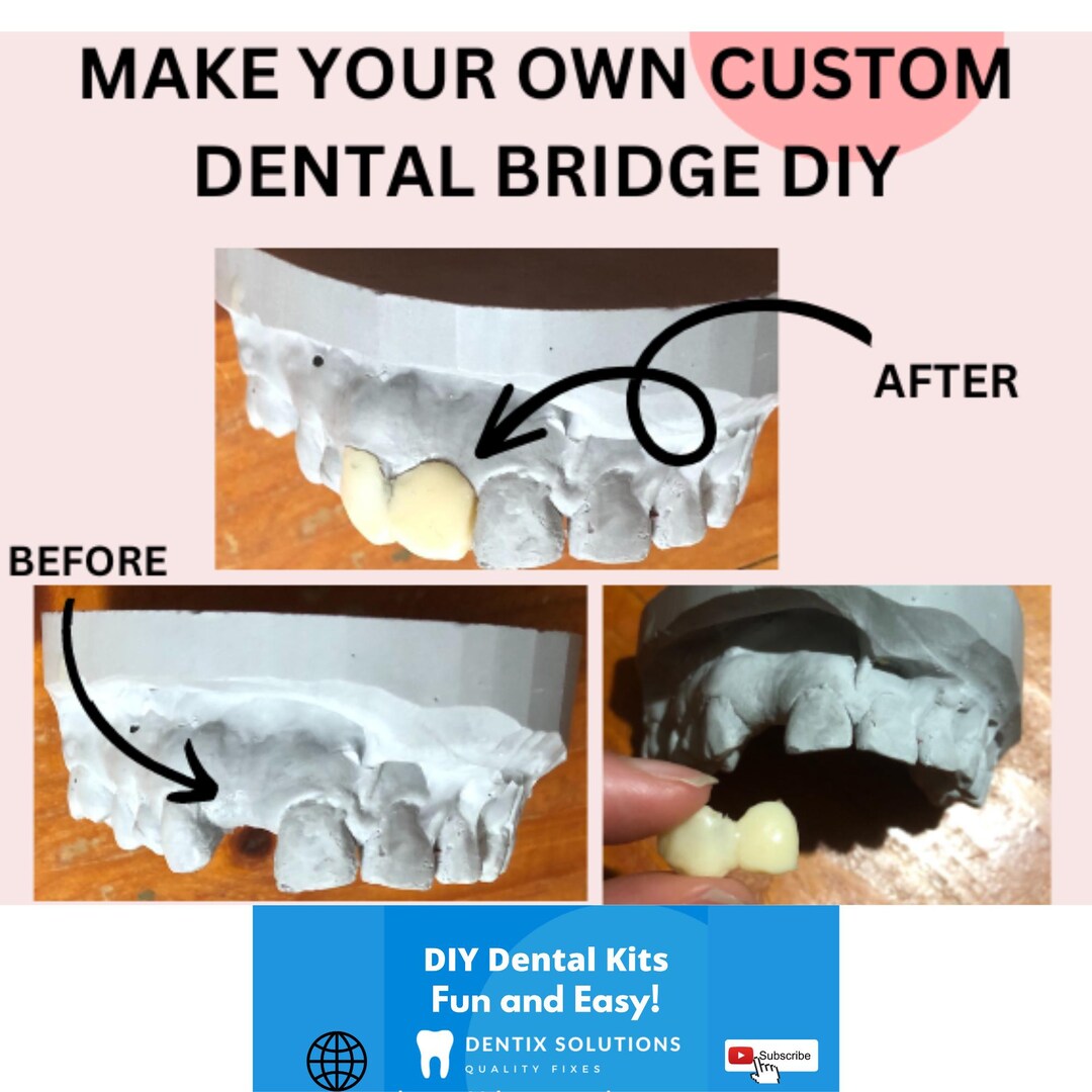 Dental Bridge DIY Custom Resin Bridge Make Your Own, Easy and Realistic ...